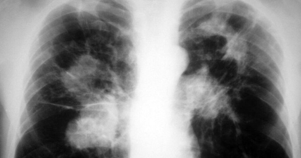 Tuberkuloza među deset vodećih zaraznih bolesti u FBiH, zaraza ne znači ...